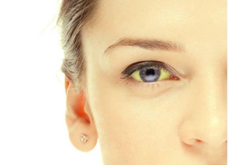 Penyakit Kuning (Jaundice): Penyebab, Gejala, dan Pengobatan | IDN Times