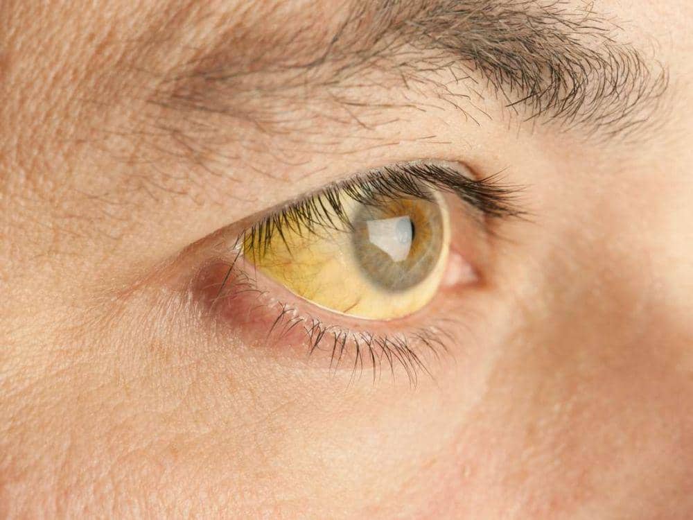 Penyakit Kuning (Jaundice): Penyebab, Gejala, dan Pengobatan | IDN Times