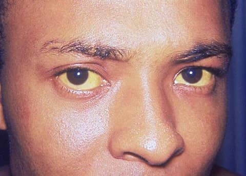Penyakit Kuning (Jaundice): Penyebab, Gejala, dan Pengobatan | IDN Times