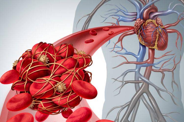 Venous Thromboembolism: Penyebab, Gejala, dan Pengobatan | IDN Times