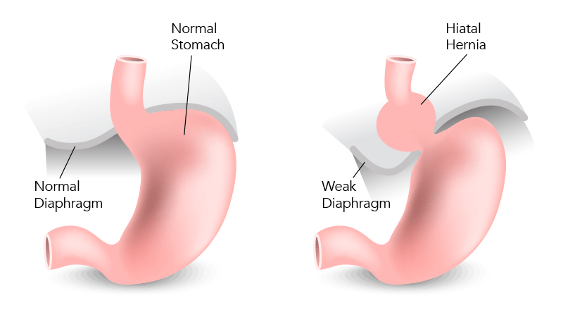 9 Penyebab Sakit di Bawah Payudara Kanan | IDN Times