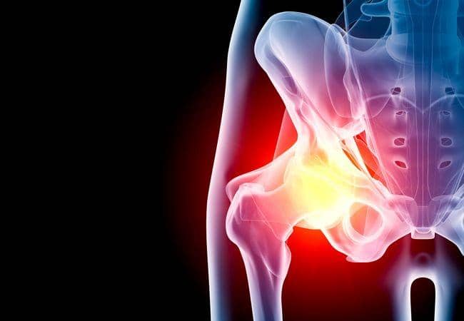 Groin Strain: Penyebab, Gejala, dan Pengobatan | IDN Times