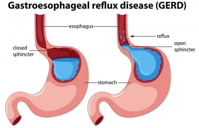 Perbedaan Heartburn, Refluks Asam, dan GERD, Kenali! | IDN Times