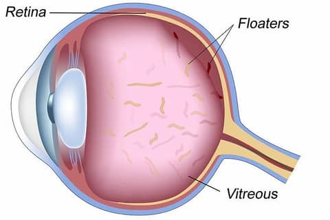 Floaters Mata: Penyebab, Gejala, Pengobatan | IDN Times