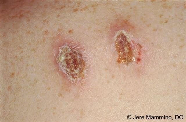 Leishmaniasis: Penyebab, Gejala, Diagnosis, Pengobatan | IDN Times