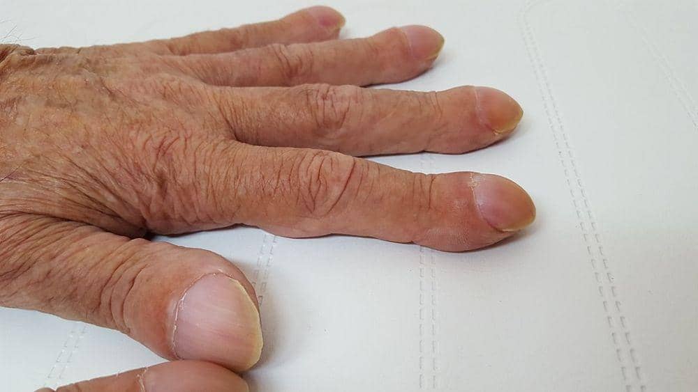 Clubbing Finger: Penyebab, Gejala, Diagnosis, dan Pengobatan | IDN Times