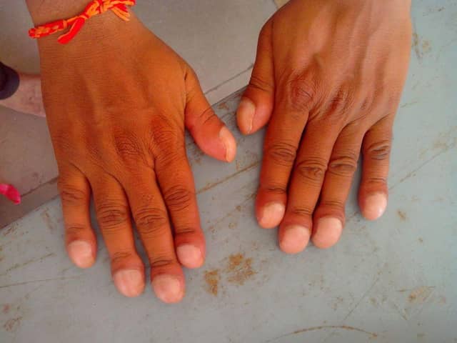 Clubbing Finger: Penyebab, Gejala, Diagnosis, dan Pengobatan | IDN Times