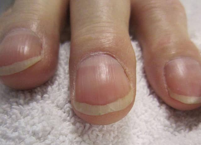 Clubbing Finger: Penyebab, Gejala, Diagnosis, dan Pengobatan | IDN Times