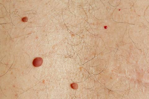 Cherry Angioma: Gejala, Penyebab, Diagnosis, dan Perawatan | IDN Times