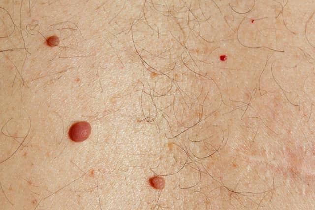Cherry Angioma: Gejala, Penyebab, Diagnosis, dan Perawatan | IDN Times