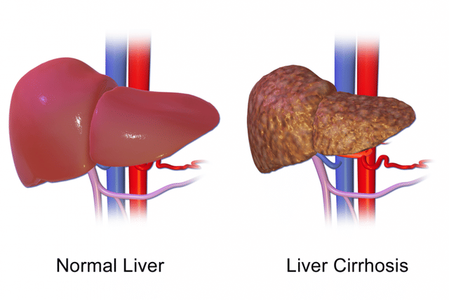 Sirosis: Penyebab, Gejala, Diagnosis, Pengobatan, Pencegahan | IDN Times