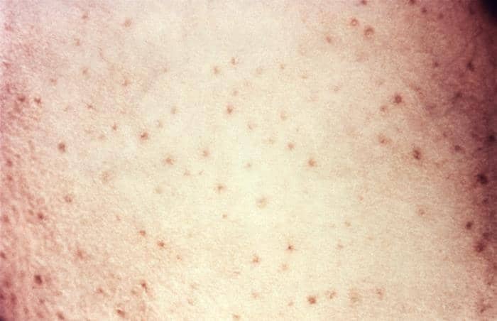 Petechiae: Penyebab, Gejala, Diagnosis, dan Pengobatan | IDN Times