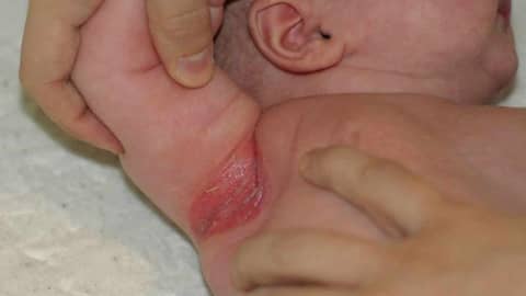 Intertrigo: Gejala, Penyebab, Diagnosis, Pengobatan | IDN Times