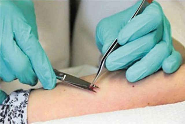 Biopsi: Tujuan, Tipe, Persiapan, dan Risiko | IDN Times
