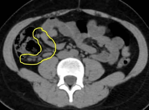 Adenitis Mesenterika: Penyebab, Gejala, Diagnosis, dan Obat | IDN Times