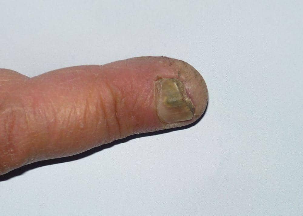 7 Jenis Infeksi Jamur Kulit yang Mesti Diwaspadai | IDN Times