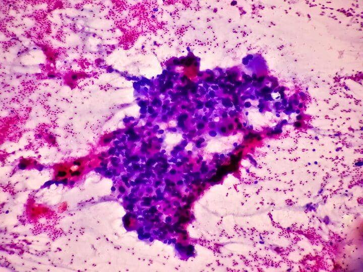 Adenokarsinoma: Jenis, Penyebab, Diagnosis, Pengobatan | IDN Times