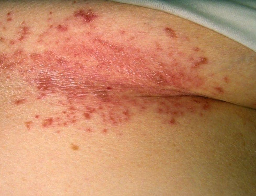 Intertrigo: Gejala, Penyebab, Diagnosis, Pengobatan | IDN Times