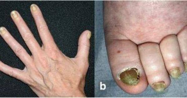 15 Masalah Kuku yang Harus Diperiksakan ke Dokter | IDN Times