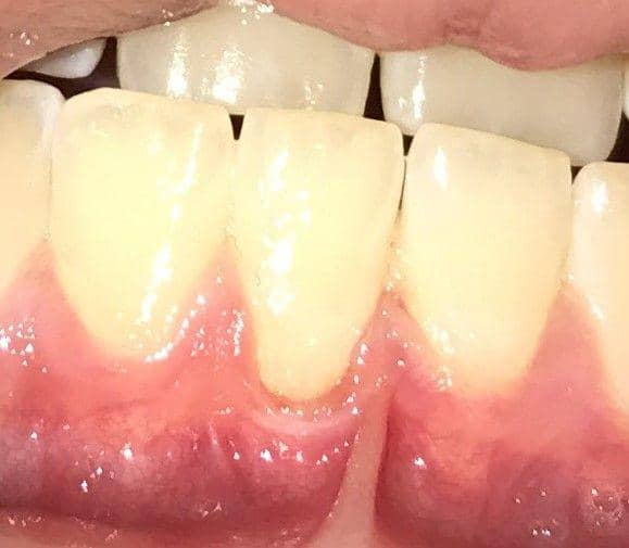 Gusi Turun (Resesi Gingiva): Penyebab, Gejala, Perawatan | IDN Times