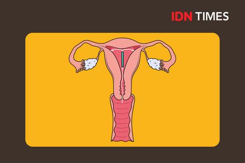 7 Tanda IUD Harus Segera Dilepas, Jangan Ditunda-tunda! | IDN Times