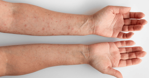 Perbedaan Bintik Merah DBD dan Biang Keringat, Jangan Tertukar! | IDN Times