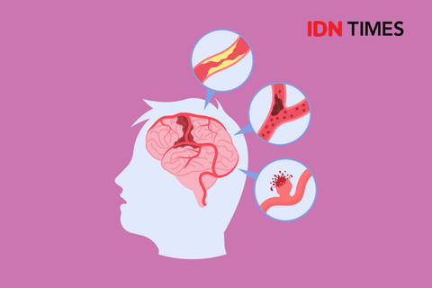 Perbedaan Stroke Iskemik dan Hemoragik, Mana yang Lebih Bahaya? | IDN Times