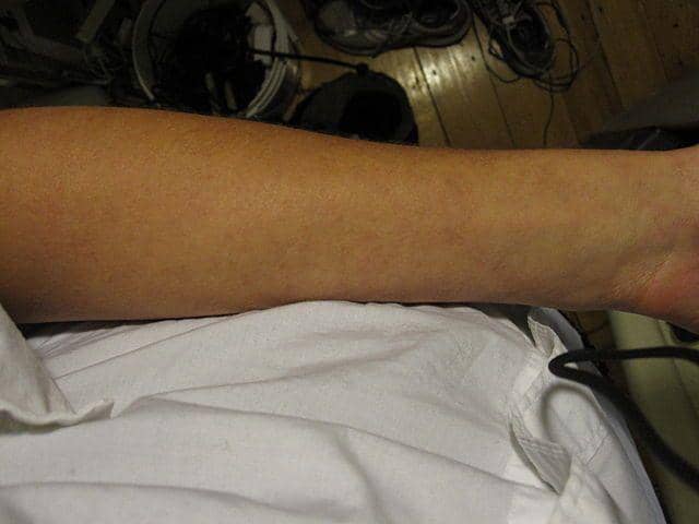 Perbedaan Bintik Merah DBD dan Biang Keringat, Jangan Tertukar! | IDN Times