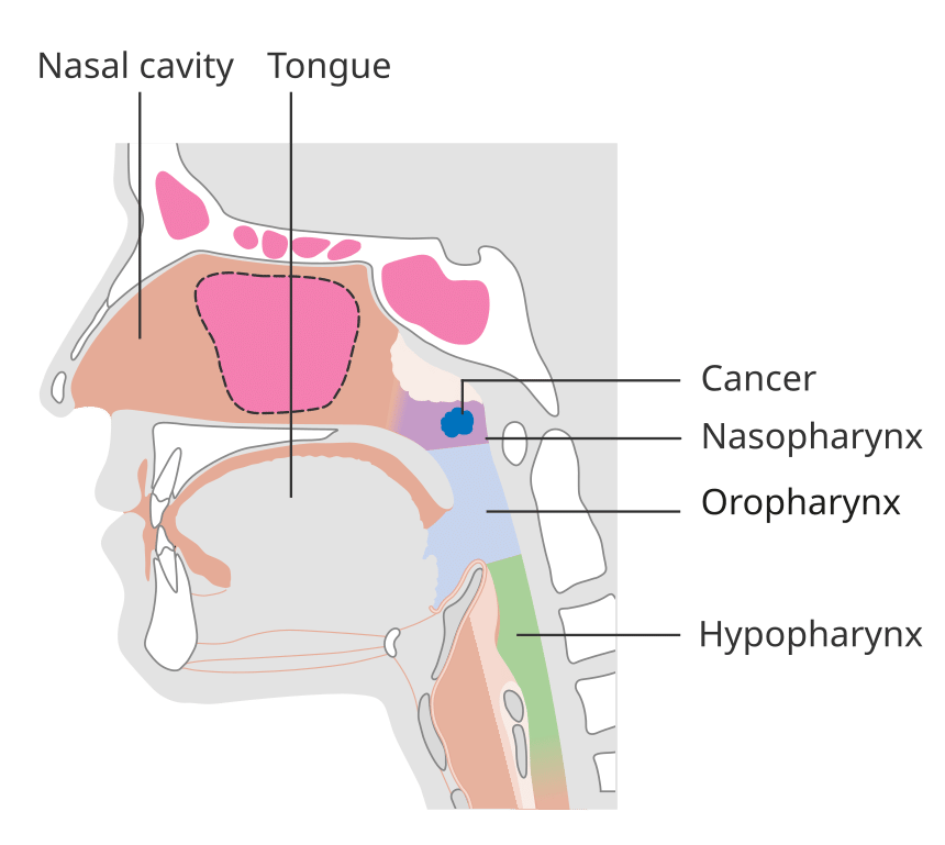 Kanker Nasofaring: Gejala, Penyebab, Diagnosis, Pengobatan | IDN Times