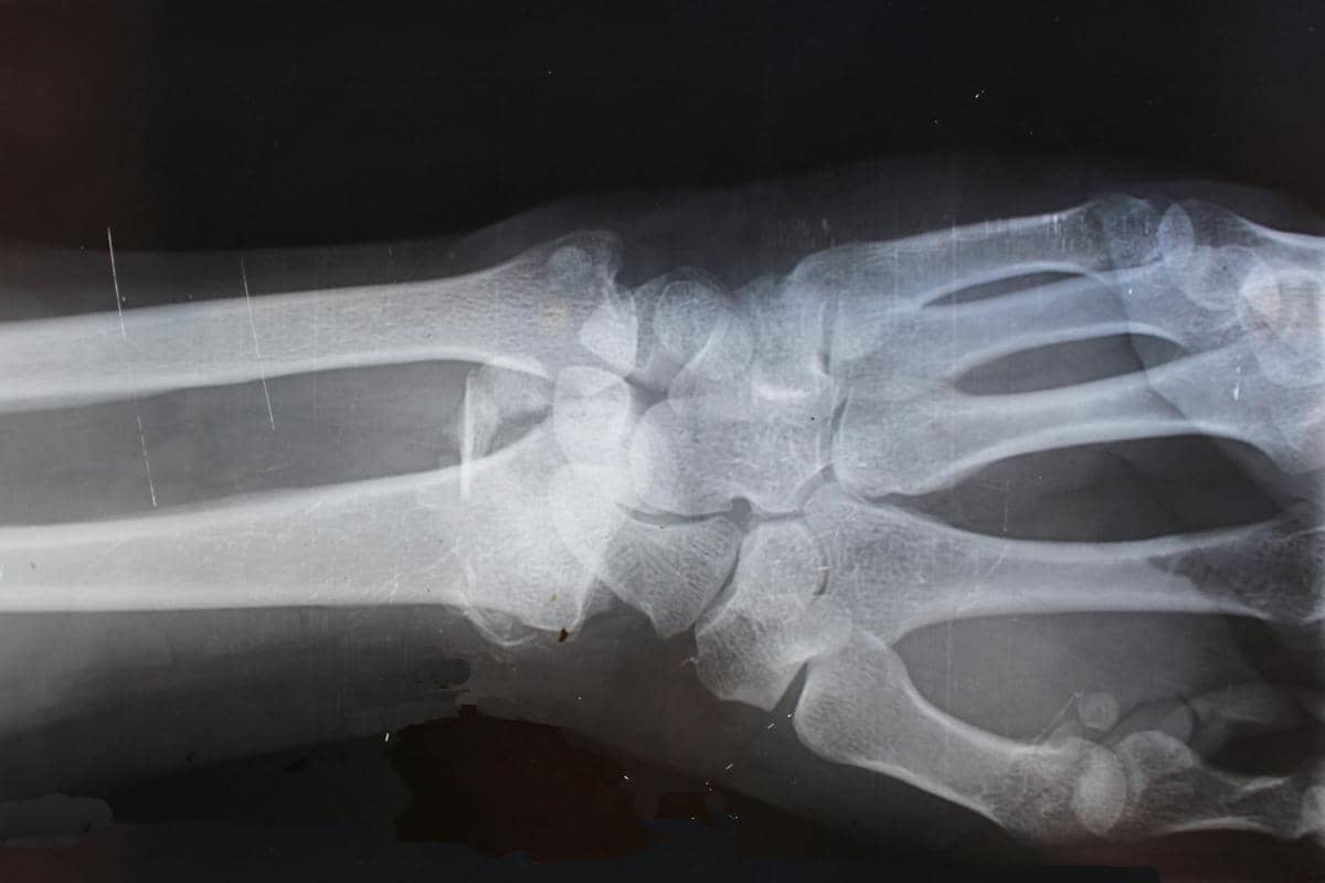 6 Macam Sendi Gerak pada Manusia yang Perlu Kamu Tahu! | IDN Times Jateng