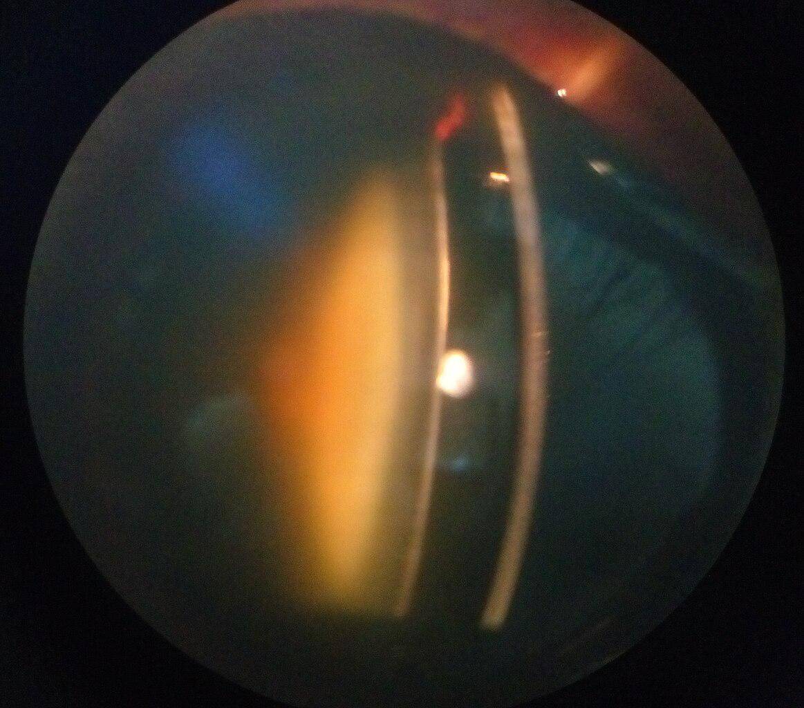 10 Jenis Katarak, Kenali Perbedaannya | IDN Times