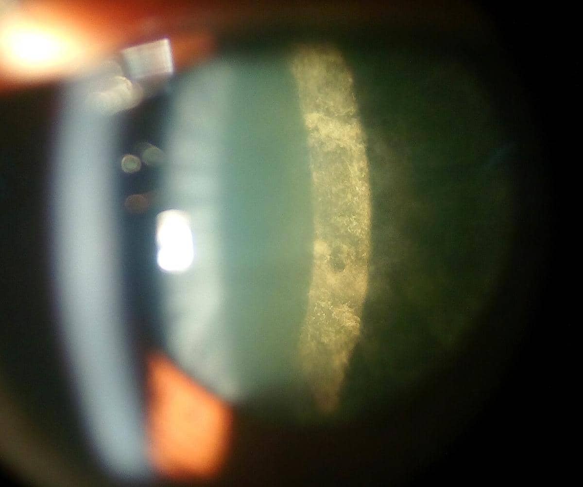 10 Jenis Katarak, Kenali Perbedaannya | IDN Times