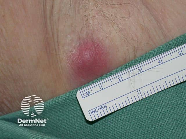 Apakah Bisul Bisa Sembuh Tanpa Obat? | IDN Times