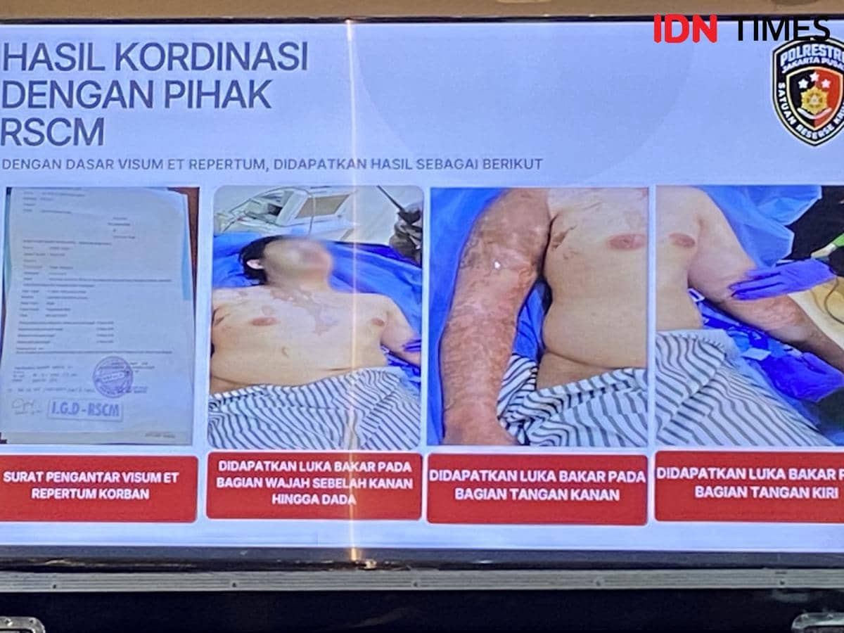 Kondisi Andrie Yunus Disiram Air Keras: Luka Bakar di Dada, Tangan ...